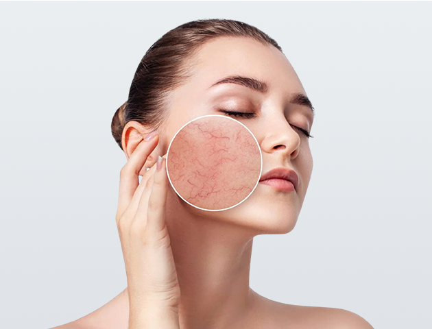 Spider Veins Glo365 Site